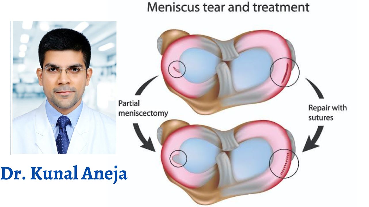 Meniscus Surgeon In Rohini- Dr. Kunal Aneja