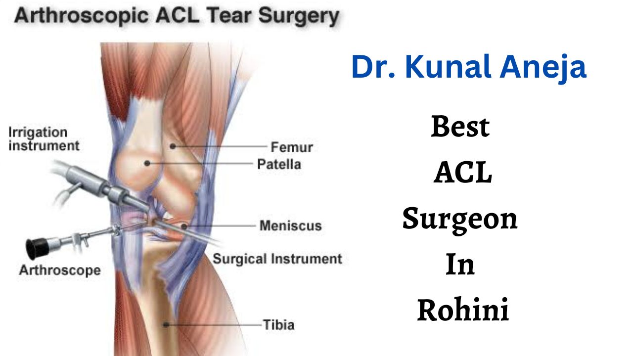 Best ACL Reconstruction Surgeon in Delhi: Dr Kunal Aneja
