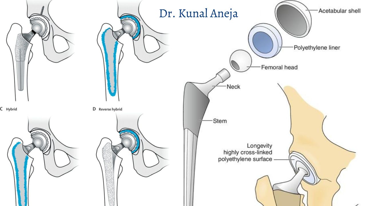 Hip Replacement Surgeon in Delhi | Dr. Kunal Aneja