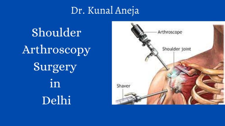 Shoulder Arthroscopy Surgery in Delhi - Dr. Kunal Aneja