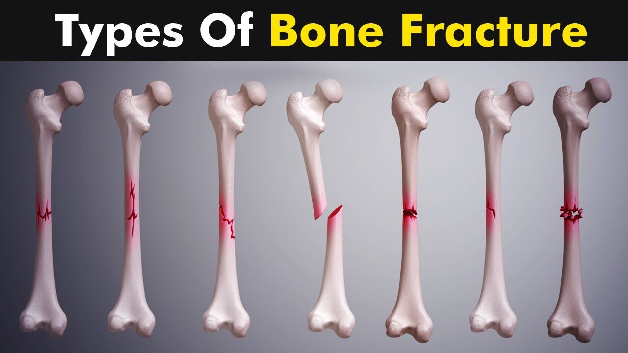 Bone Fracture Treatment - Dr. Kunal Aneja