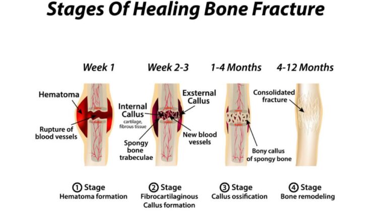 Bone Fracture Treatment - Dr. Kunal Aneja
