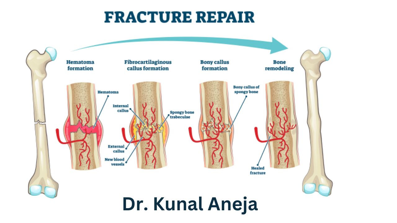 Bone Fracture Treatment - Dr. Kunal Aneja