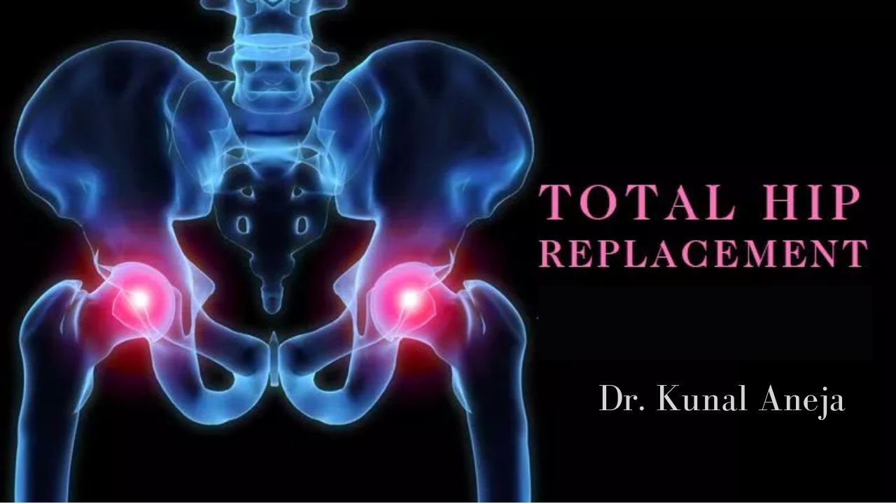 Total hip Replacement in Delhi - Dr. Kunal Aneja
