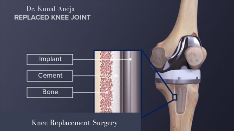 Knee Replacement Surgeon in Delhi - Dr. Kunal Aneja