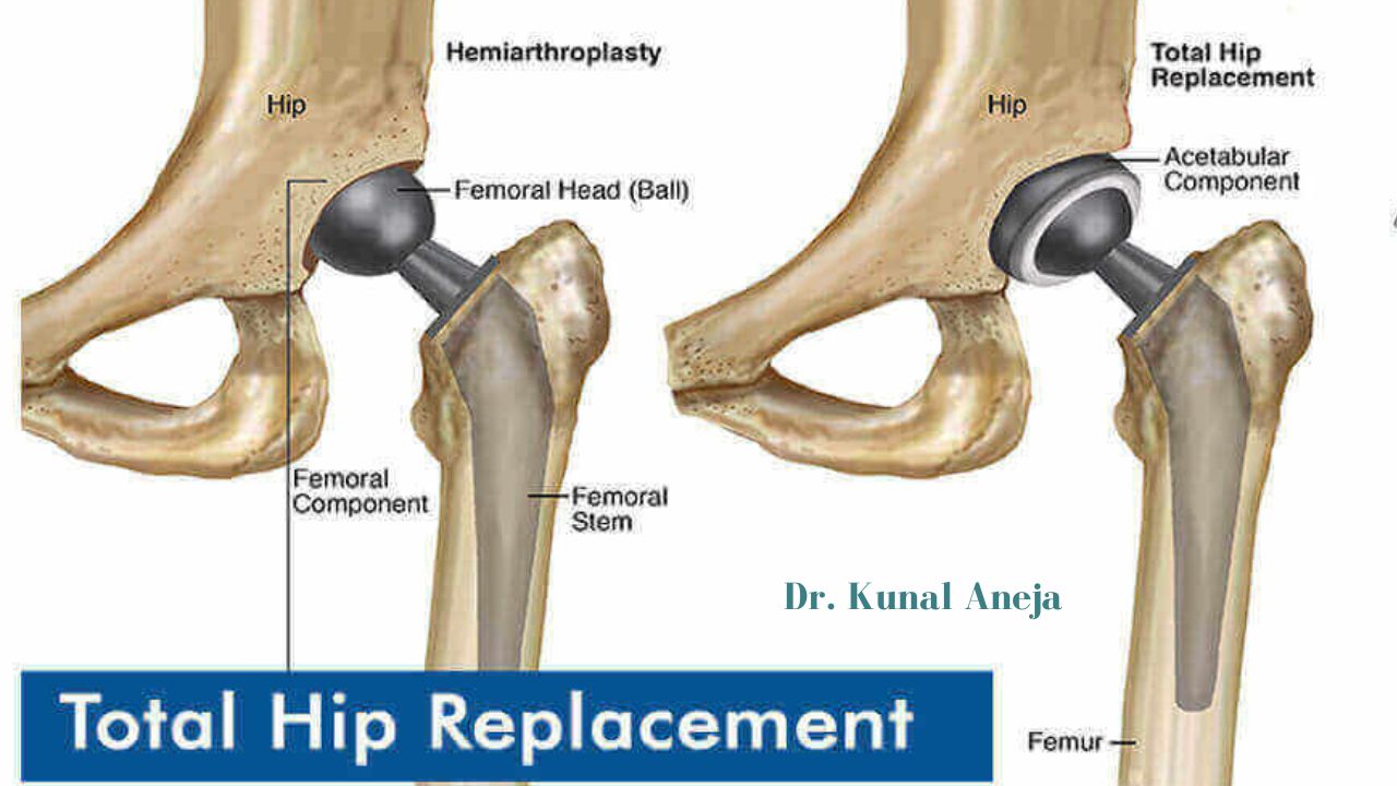 Best Hip Replacement Surgeon in Delhi / NCR - Dr. Kunal Aneja