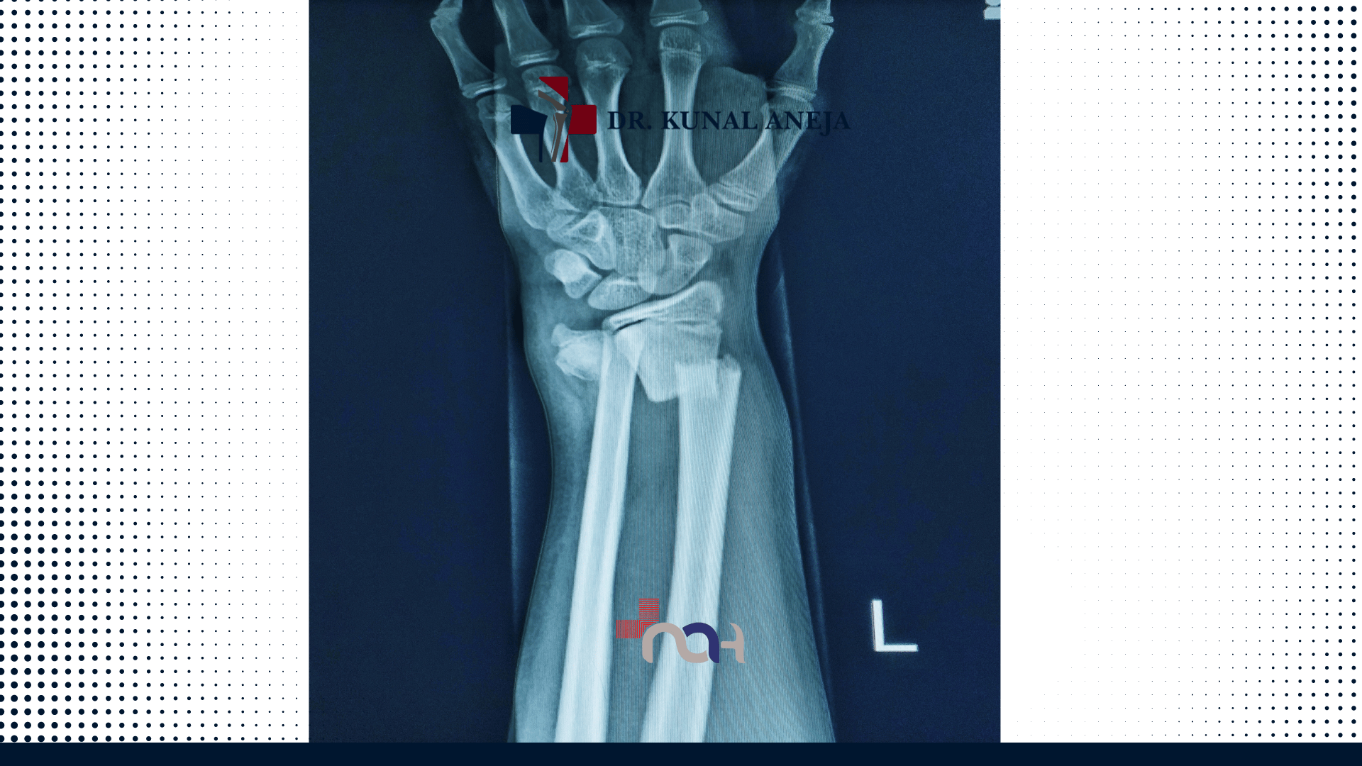 The Ultimate Guide to Bone Fracture Healing: 7 Steps to a Speedy Recovery