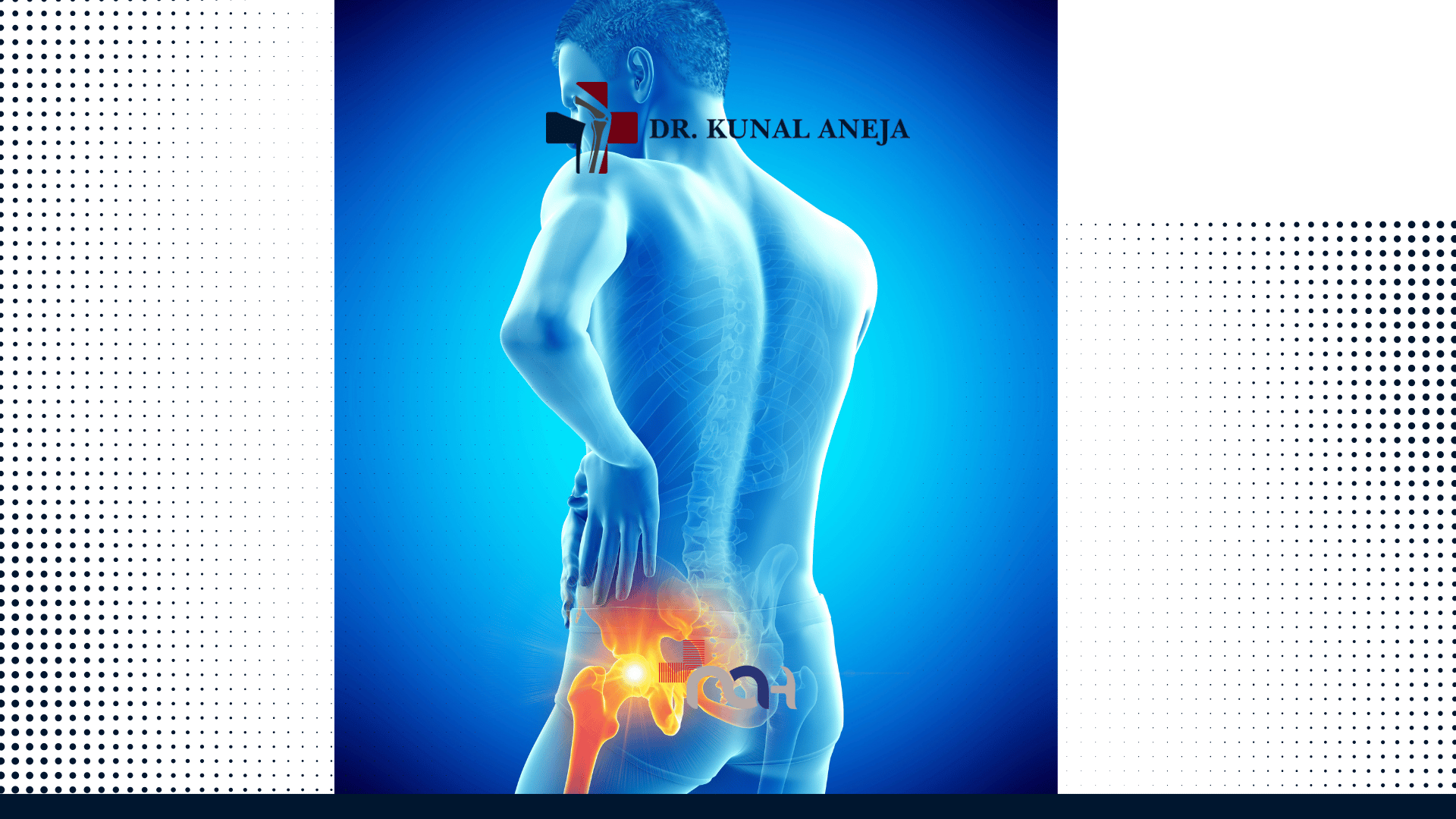 Top-Quality Hip Replacement Surgery in Delhi by Dr. Kunal Aneja